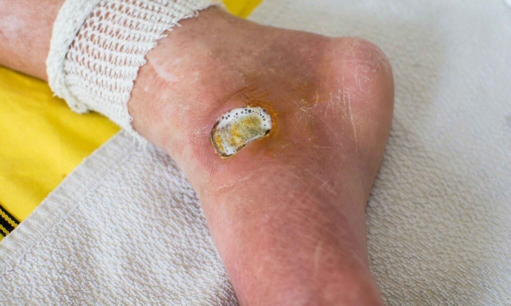 Arterial Ulcers | Expert Guide to Diagnosis and Wound Care