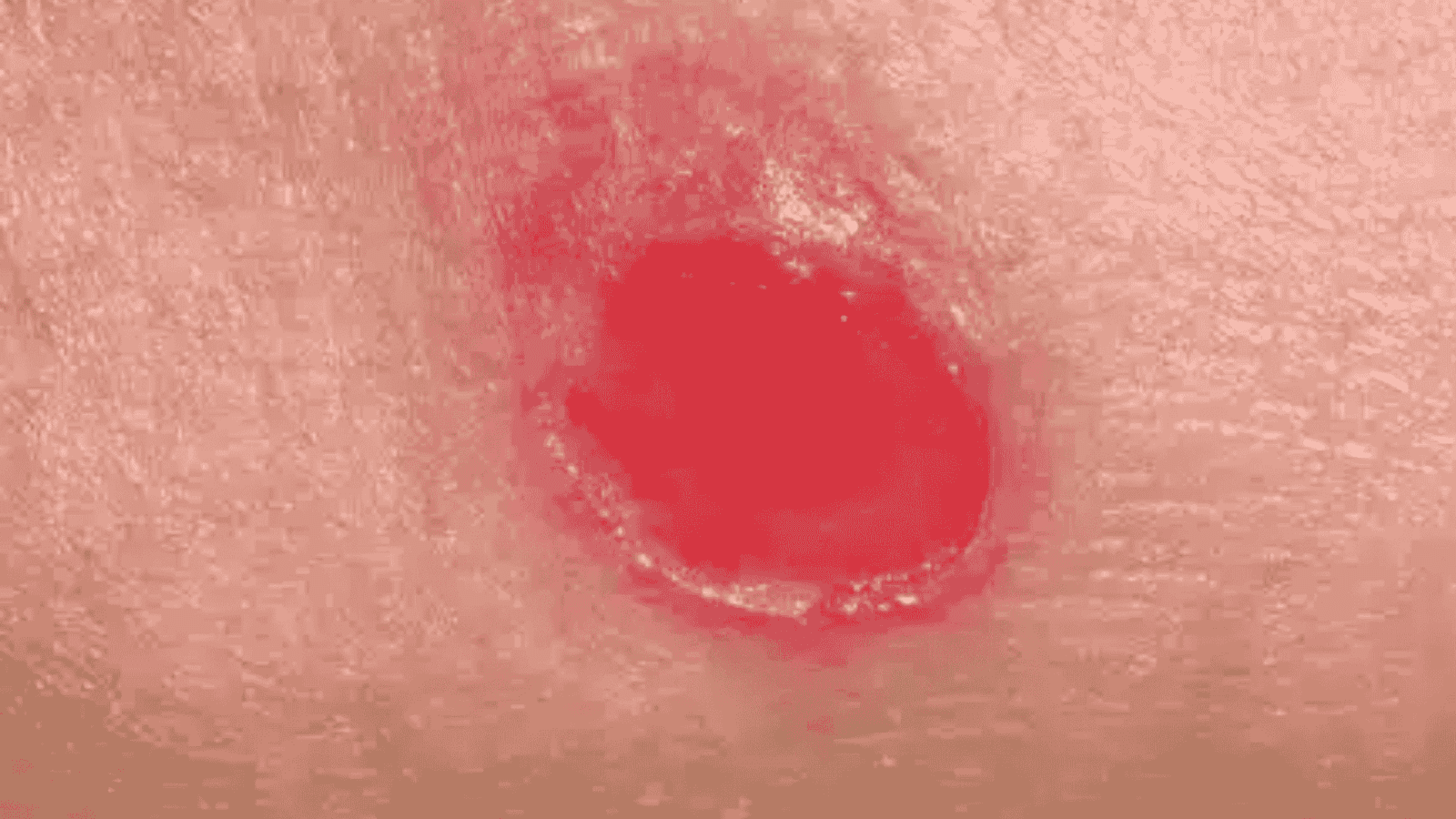 Pressure Ulcers Wound Care | Treatment and Healing Guide