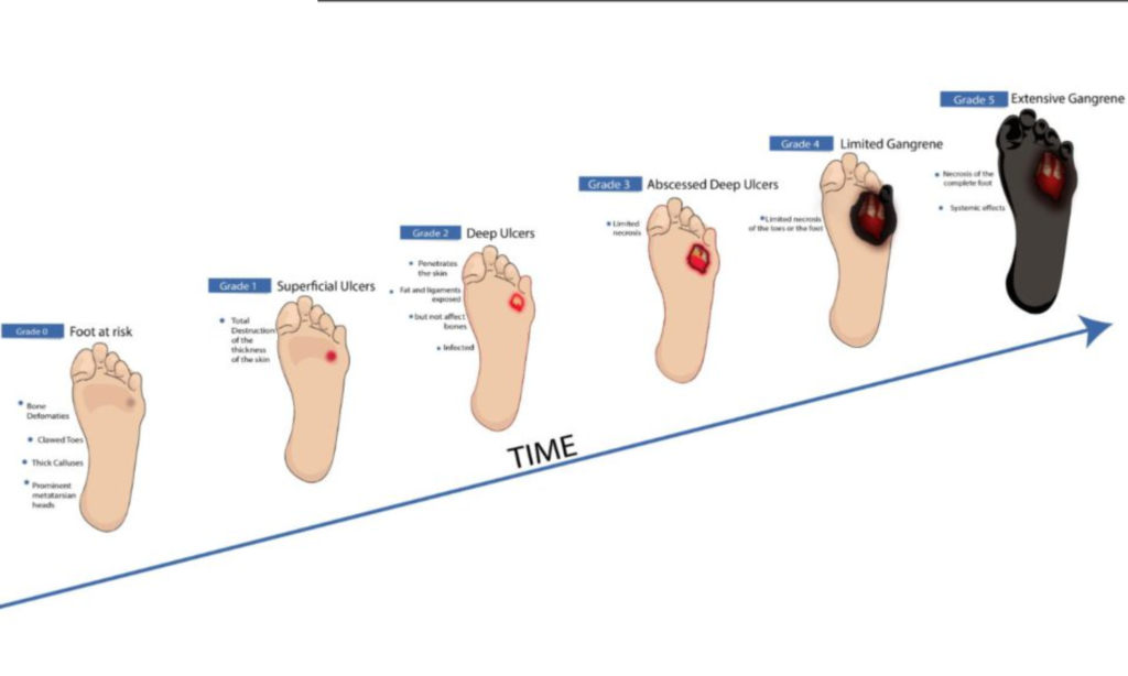 6 Stages of Diabetic Foot Ulcers & Early Treatment Guide